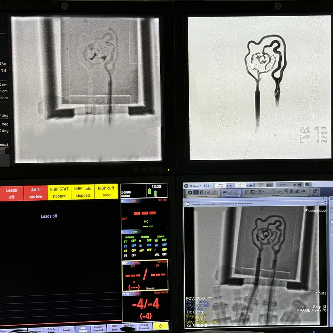 AVM Embolization Model | AVM Treatment & Surgical Training